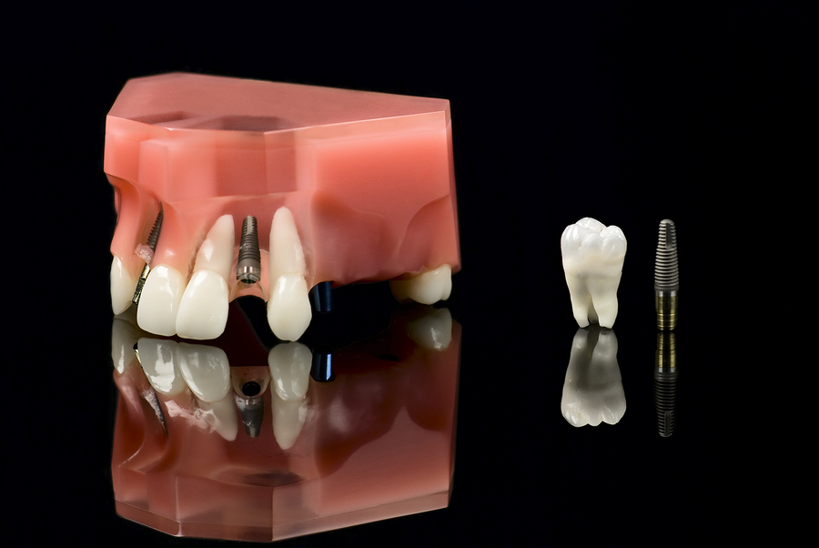 What Are Mini Dental Implants?